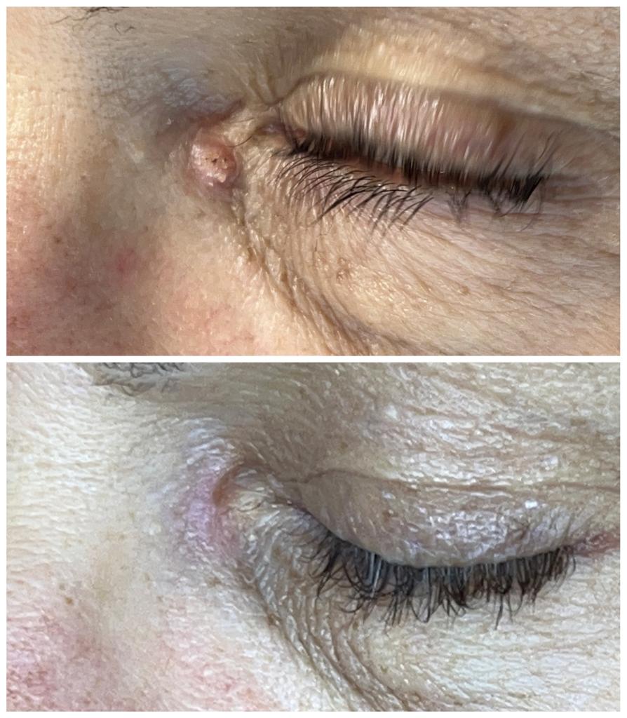 Mole, Cyst and Benign Lesion Removal — The Door W4