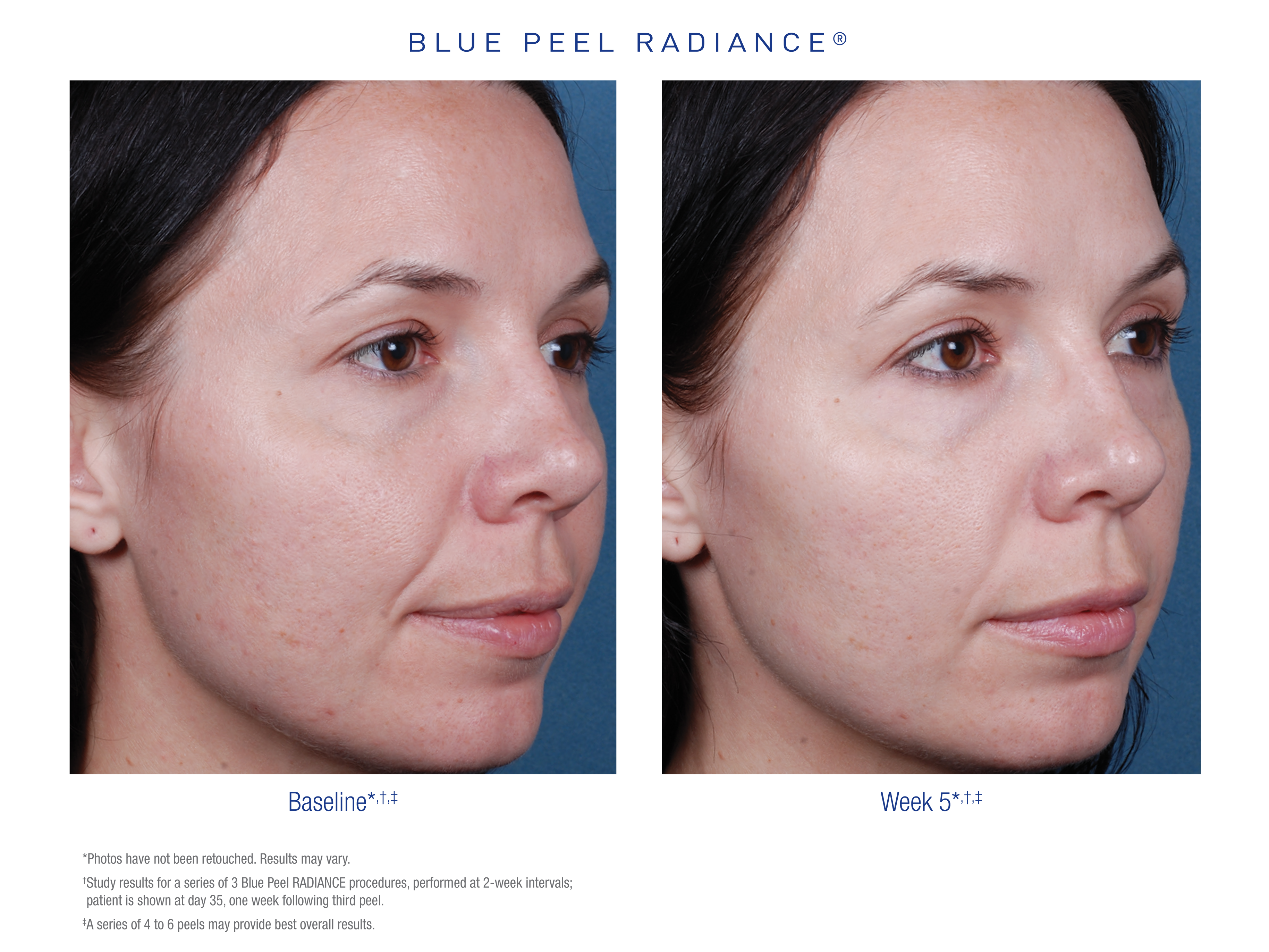 Obagi Blue Peel RADIANCE® — The Door W4