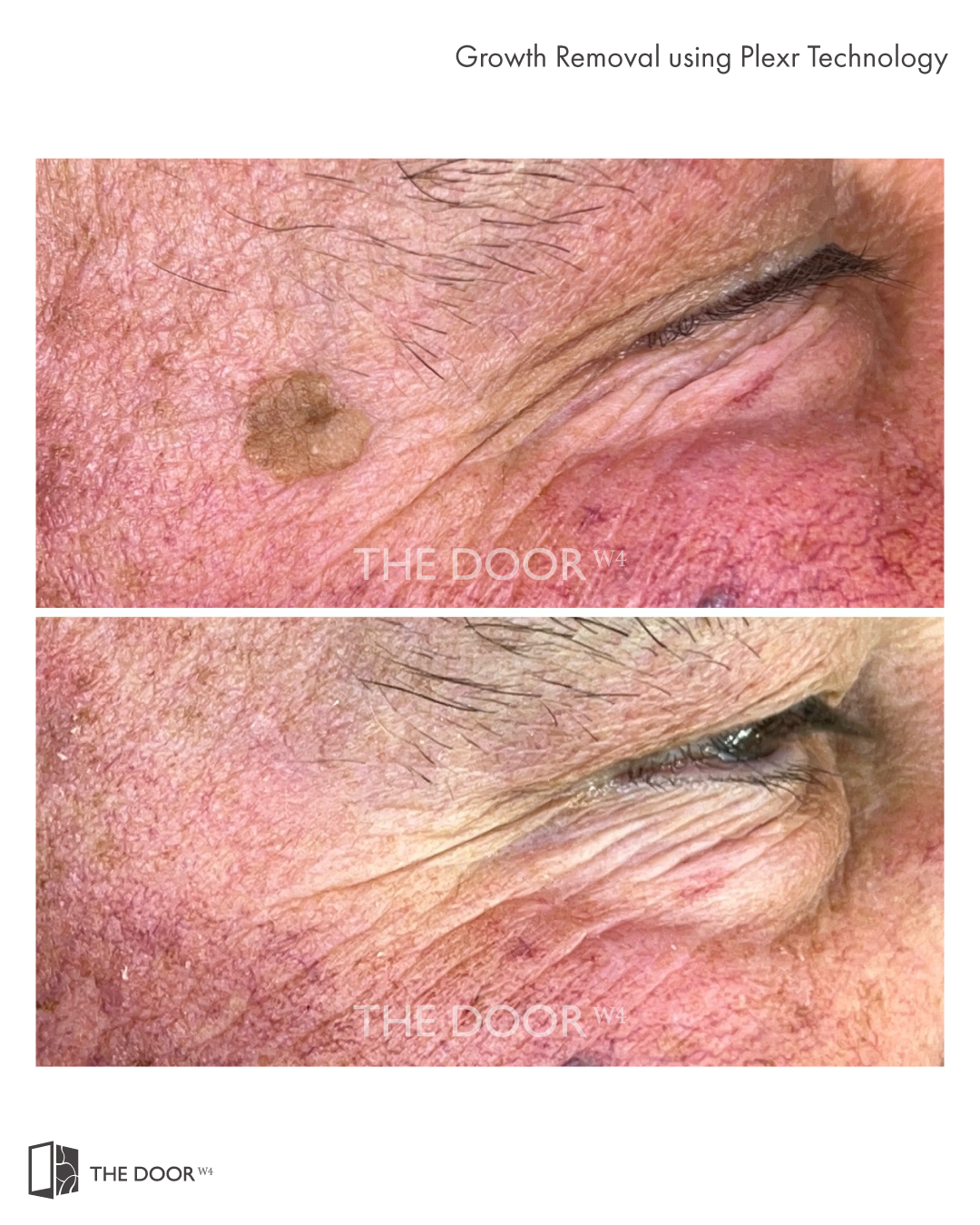 Mole, Cyst and Benign Lesion Removal — The Door W4
