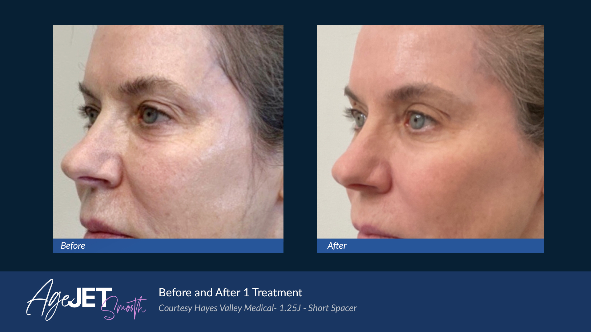 AgeJET Nitrogen Plasma Therapy — The Door W4