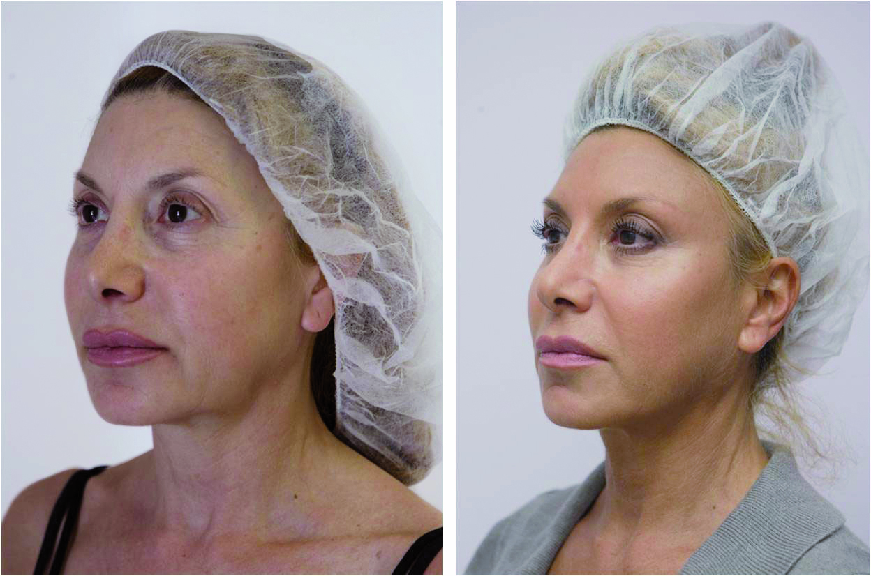 Silhouette Soft Thread Lift — The Door W4