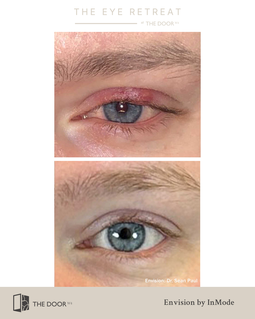 Forma-I Radiofrequency (RF) Therapy — The Door W4