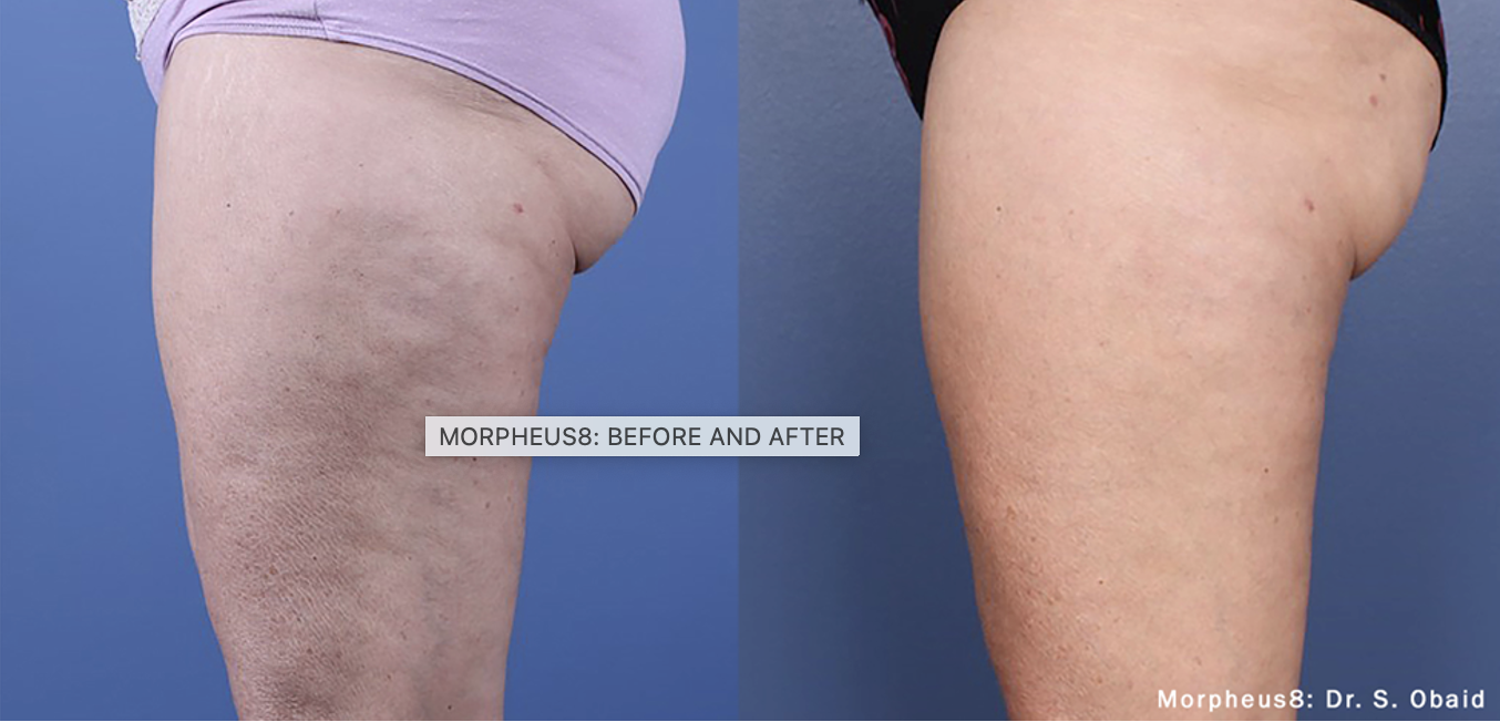 Morpheus8 Body with 3D Burst — The Door W4