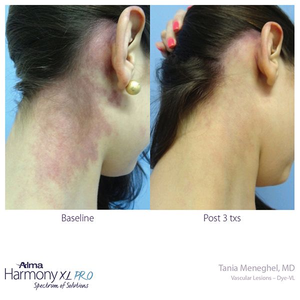 Dye Vascular Lesions (DYE VL) — The Door W4
