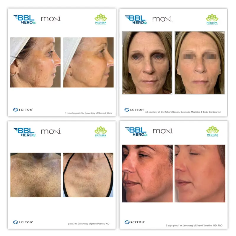 BBL HEROic® and Moxi by Sciton For Skin Rejuvenation