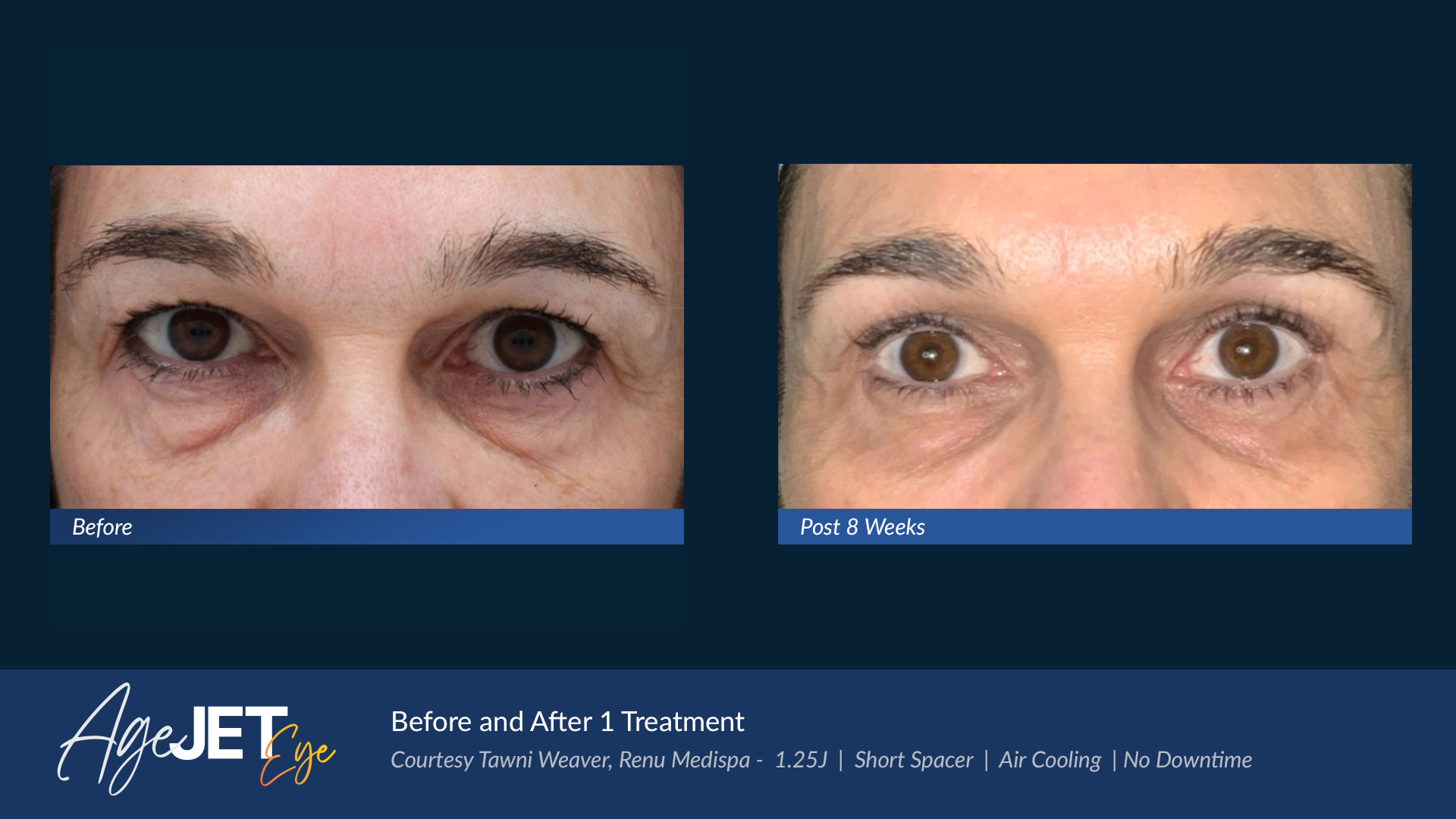 AgeJET Nitrogen Plasma Therapy — The Door W4