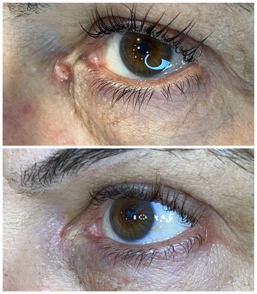 Mole, Cyst and Benign Lesion Removal — The Door W4