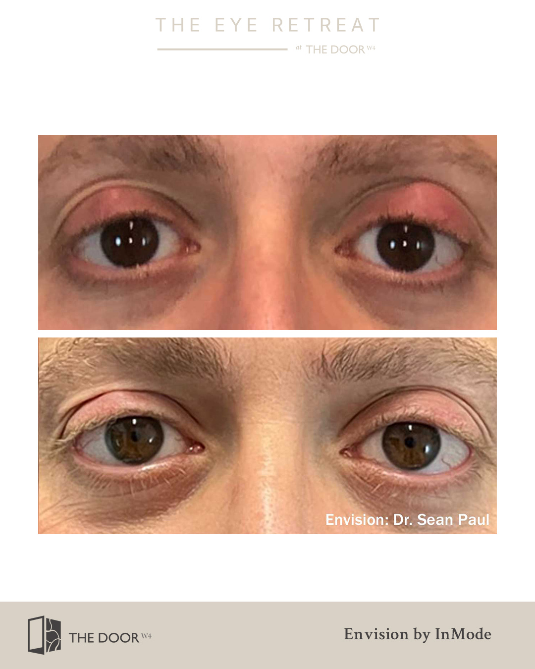 Forma-I Radiofrequency (RF) Therapy — The Door W4