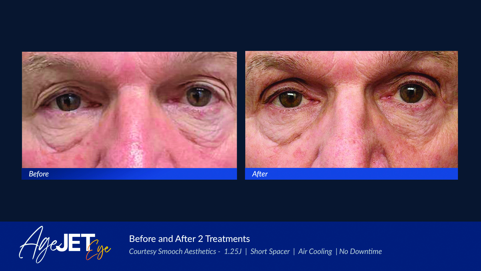 AgeJET Nitrogen Plasma Therapy — The Door W4