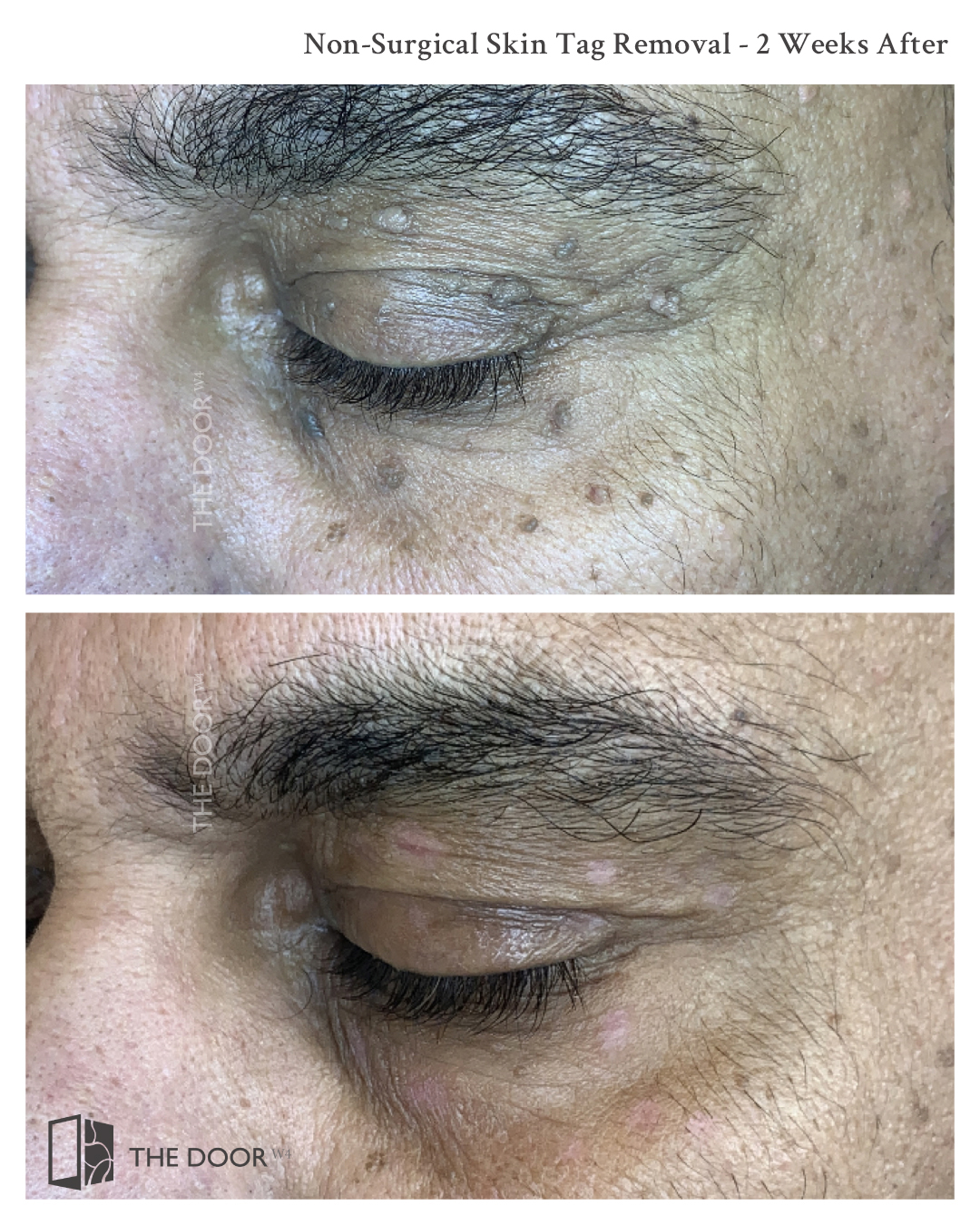 Mole, Cyst and Benign Lesion Removal — The Door W4