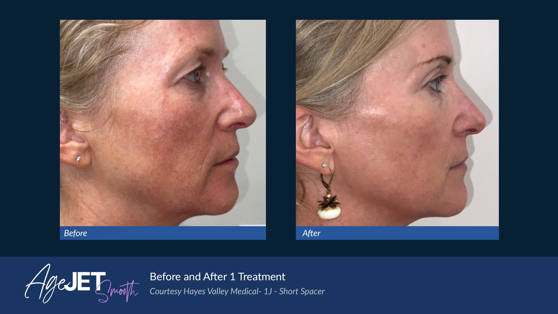 AgeJET Nitrogen Plasma Therapy — The Door W4