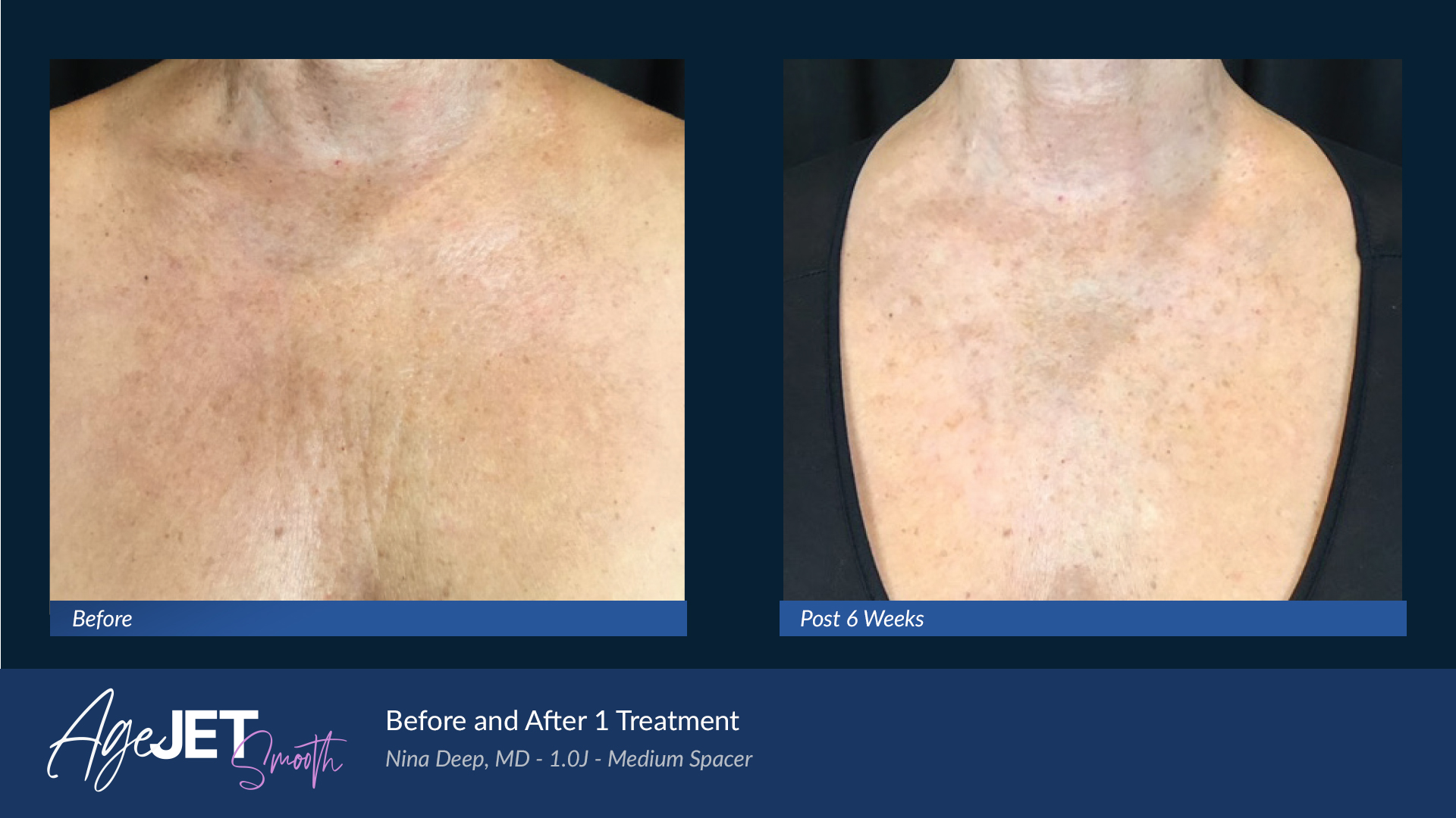 AgeJET Nitrogen Plasma Therapy — The Door W4