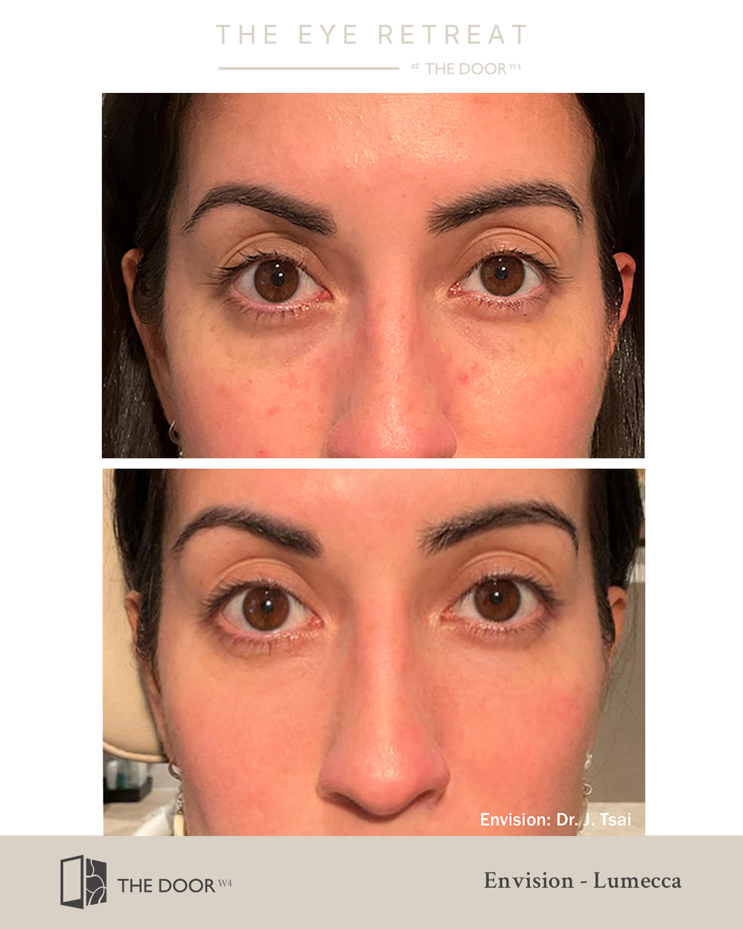 Lumecca-I Intense Pulsed Light (IPL) Therapy — The Door W4