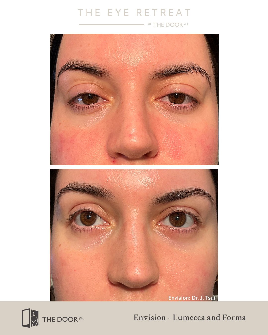 Forma-I Radiofrequency (RF) Therapy — The Door W4