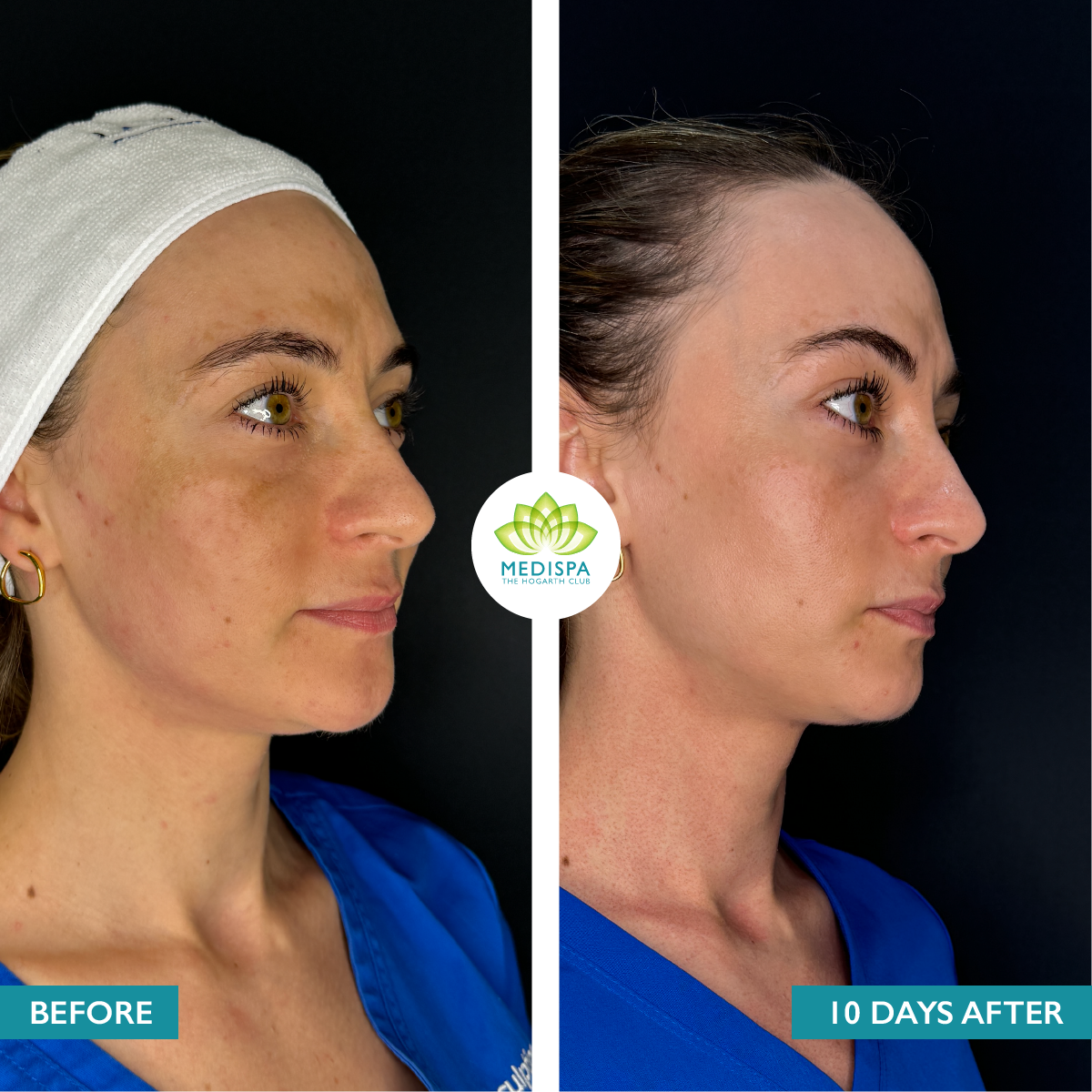 BBL HEROic® and Moxi by Sciton For Skin Rejuvenation