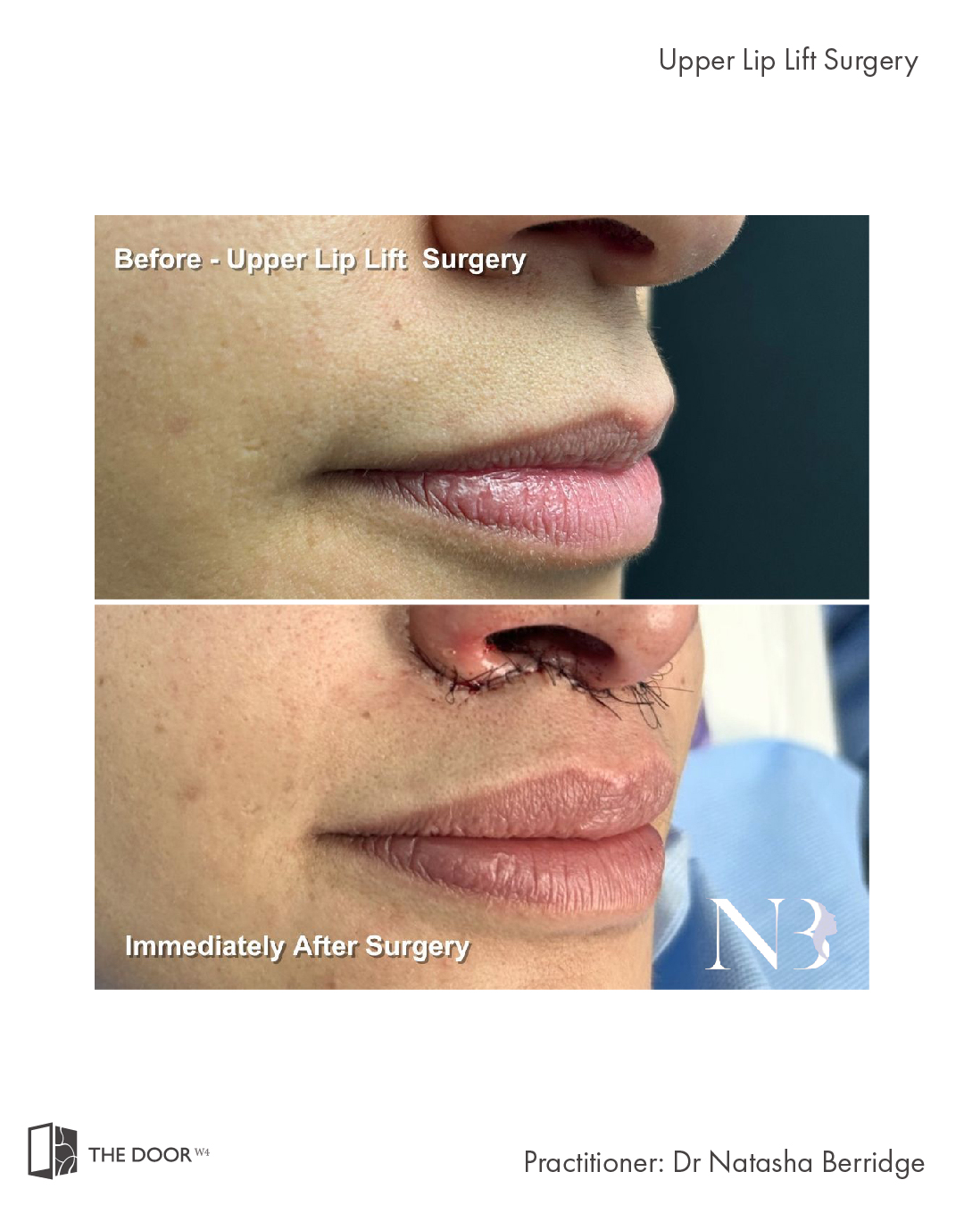 Surgical Lip Lift — The Door W4