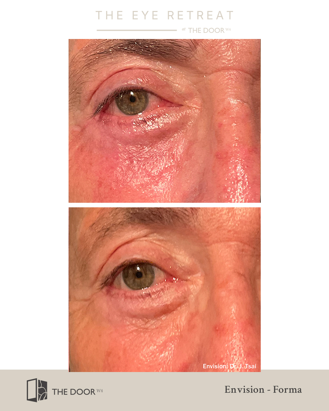 Forma-I Radiofrequency (RF) Therapy — The Door W4