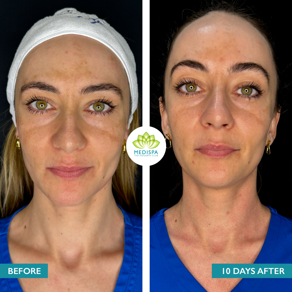 BBL HEROic® and Moxi by Sciton For Skin Rejuvenation