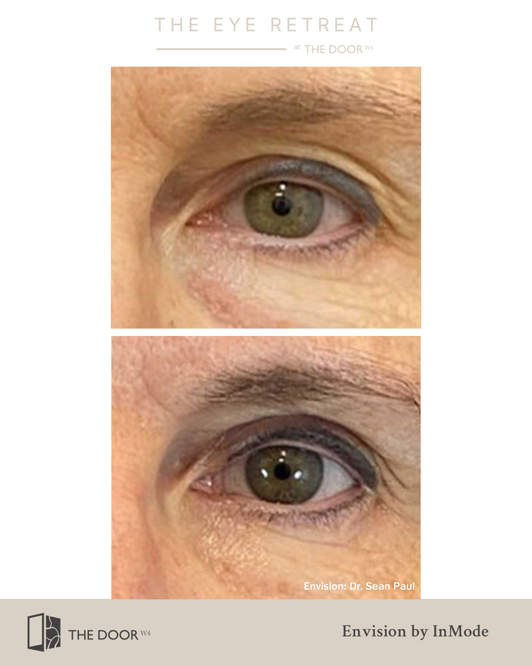 Forma-I Radiofrequency (RF) Therapy — The Door W4