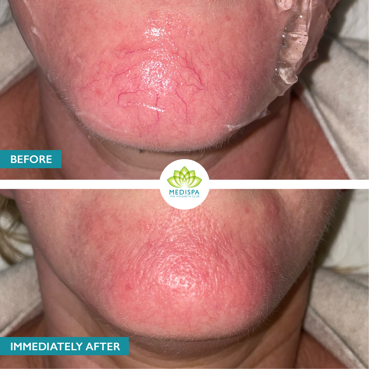 BBL HEROic® and Moxi by Sciton For Skin Rejuvenation